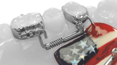Distalizers | Ricoh Orthodontic Appliances