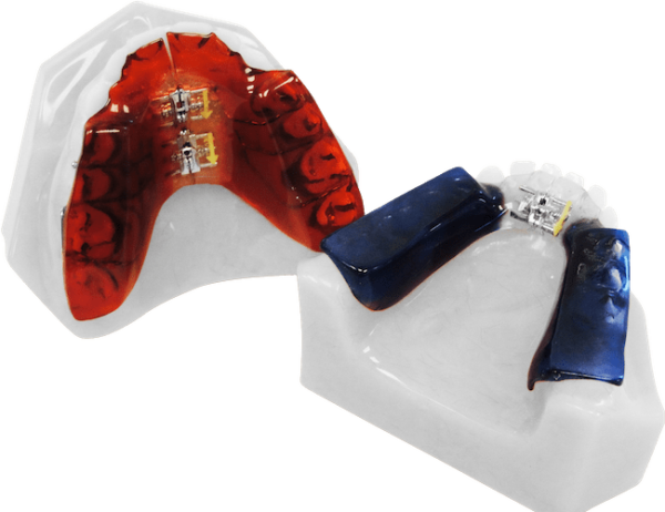 Active Plates and Splints | Ricoh Orthodontic Appliances
